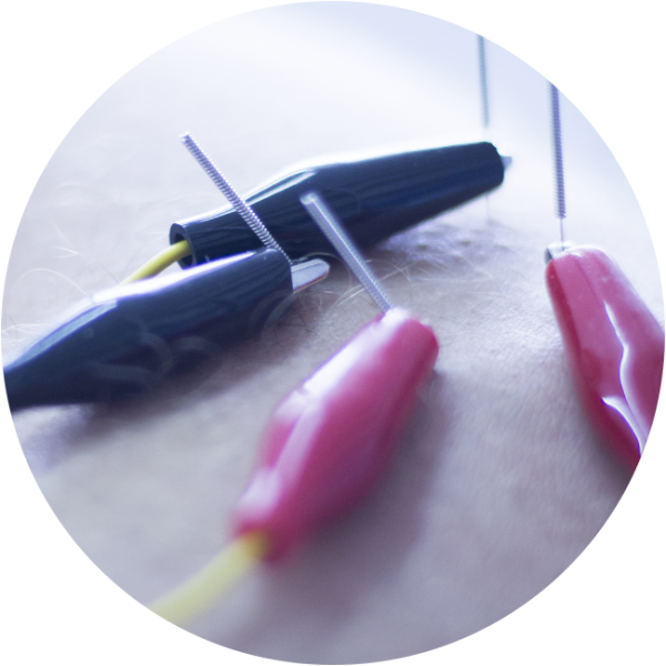 Electro Acupuncture - Spruce Acupuncture